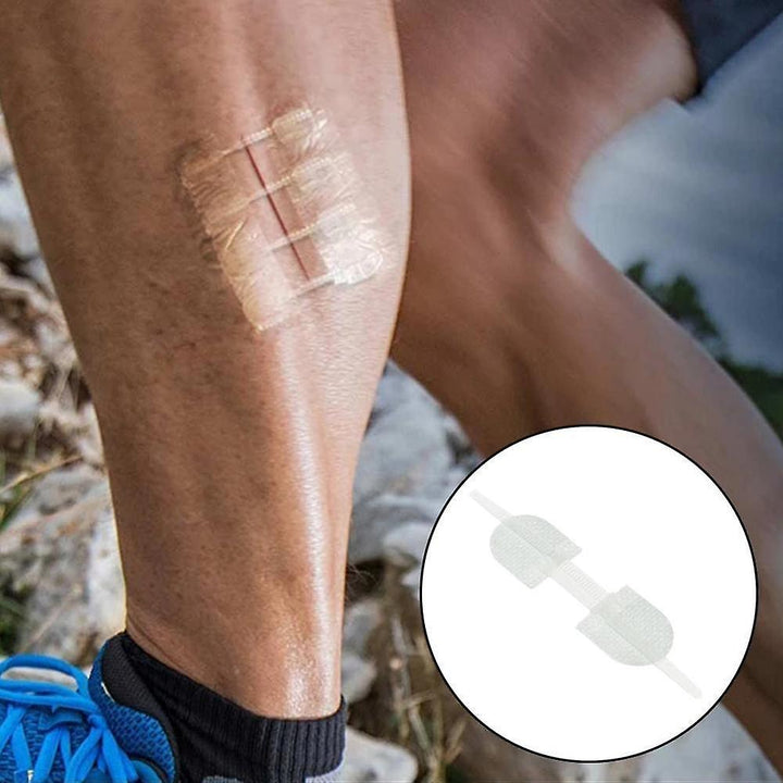 Buy ZipStitch for Lacerations - Buy painless wound closure – ZipStitch ...