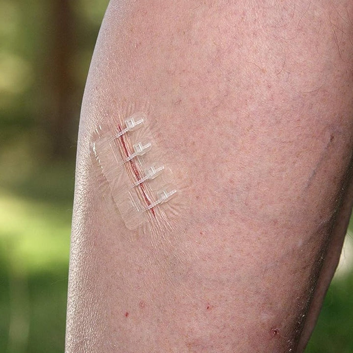 Surgical-Quality Skin Closure - Non-Invasive Wound Closure – ZipStitch ...